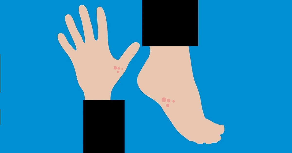 【ダニ恐怖症】人はなぜダニが怖いのか？ダニに恐怖する意外な原因とは？ | 心理学・スピリチュアル研究所